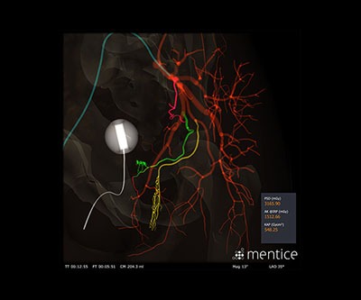 Mentice releases world’s first endovascular simulation training ...