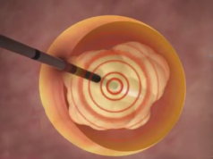 Solero microwave ablation system gets CE mark - Interventional News