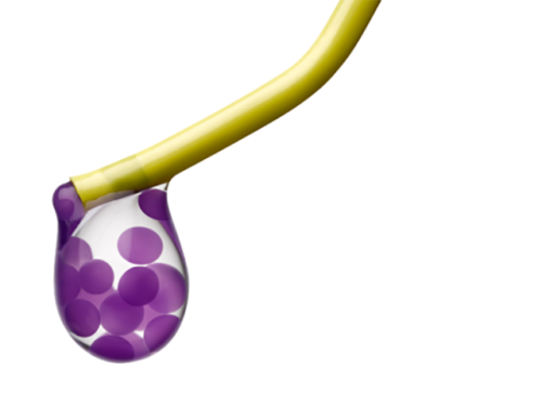 embozene-indicated-prostate-artery-embolization-US