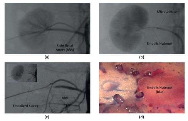 Flowing on the horizon: Liquid embolics in development | Suvranu Ganguli