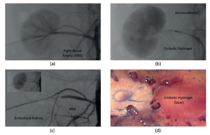 Flowing on the horizon: Liquid embolics in development | Suvranu Ganguli