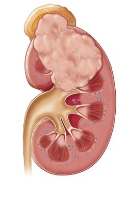 kidney-side-view - Interventional News