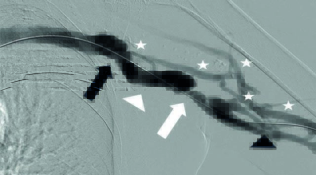 Treating venous anastomotic stenoses with the COVERA Covered Stent