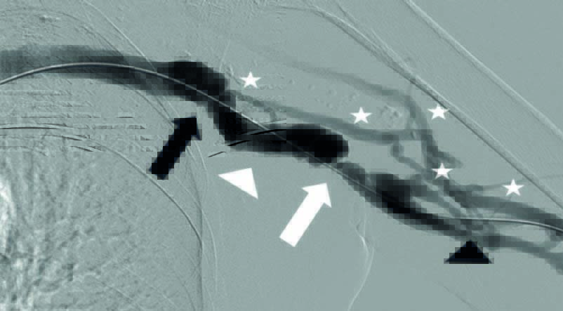 Treating venous anastomotic stenoses with the COVERA Covered Stent