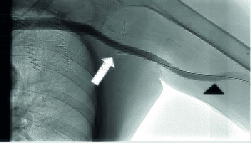 Treating venous anastomotic stenoses with the COVERA Covered Stent