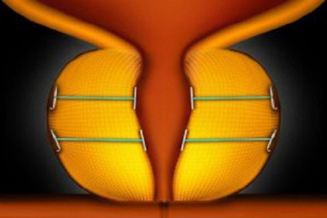 New data show early intervention with UroLift system improves long-term ...