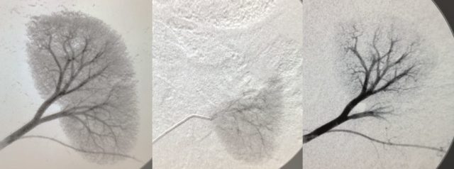 Fair-Embo project maps interventional radiology services across the world