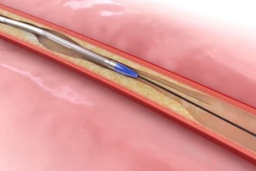 Flex vessel preparation system limits complications in the fempop arteries