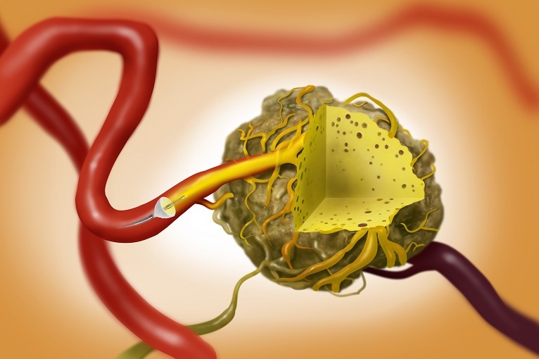 TriNav infusion system launches to overcome infusion barriers in tumours