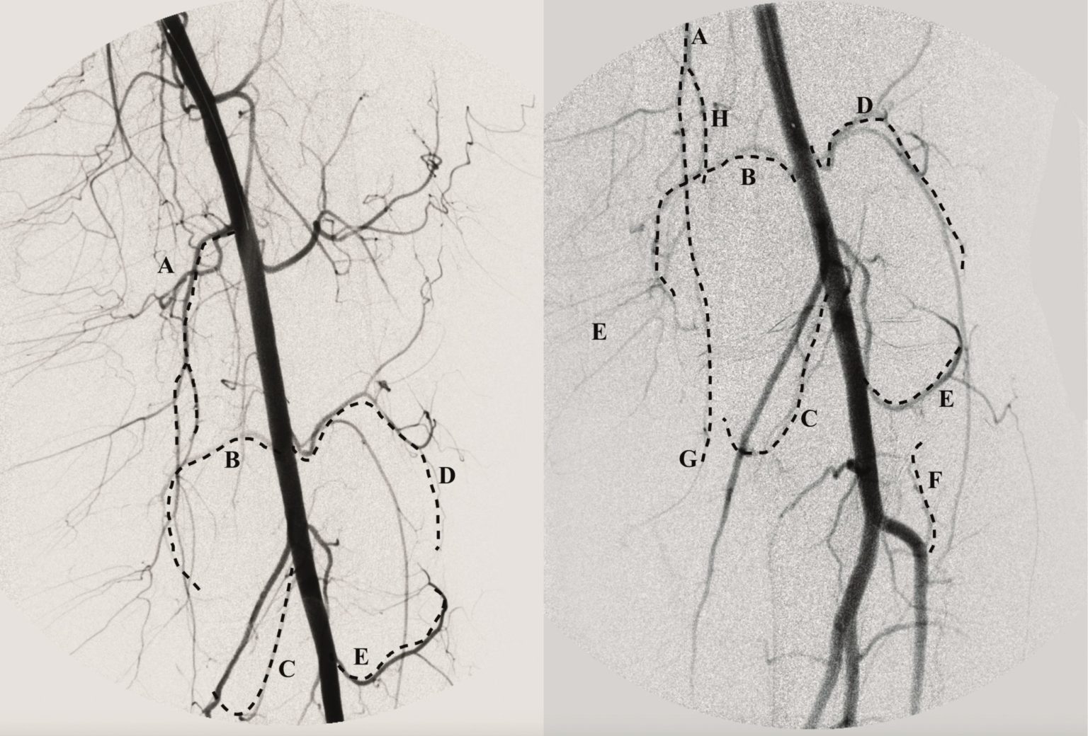 Tips to recognising genicular artery anatomy - Interventional News