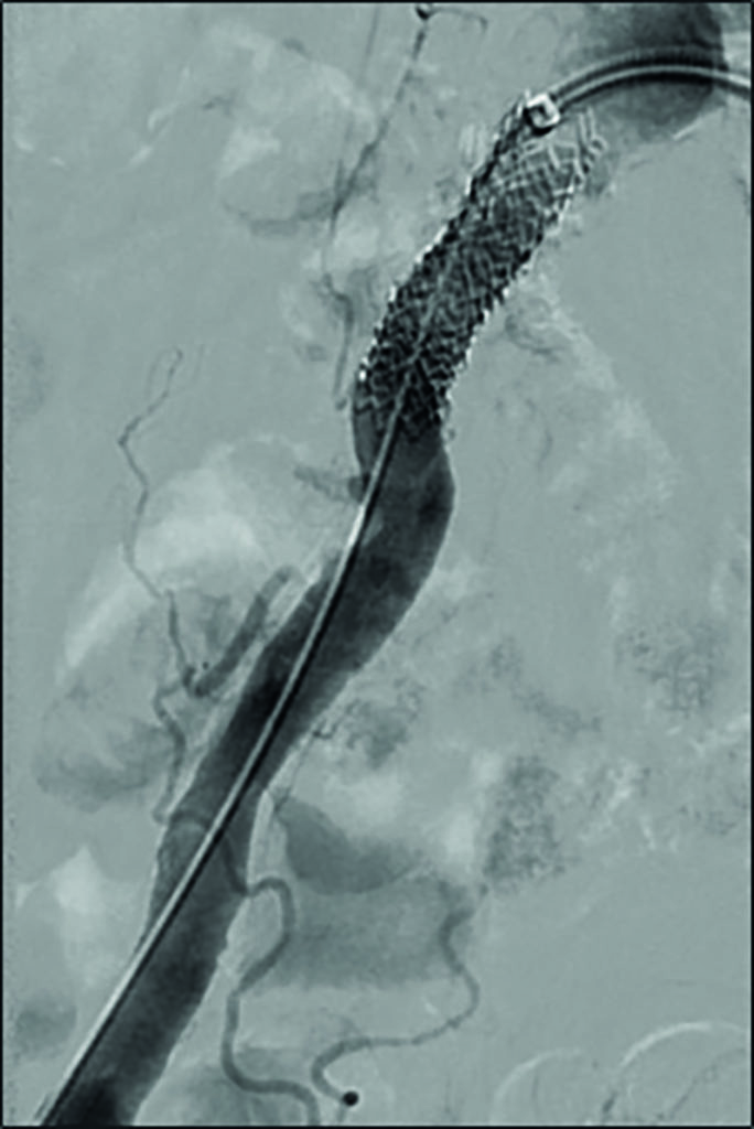 Balloon-expandable covered stent reveals promise as endovascular ...