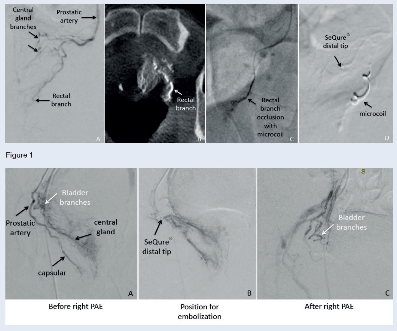 SeQure® microcatheter reduces risks of non-target embolization in PAE