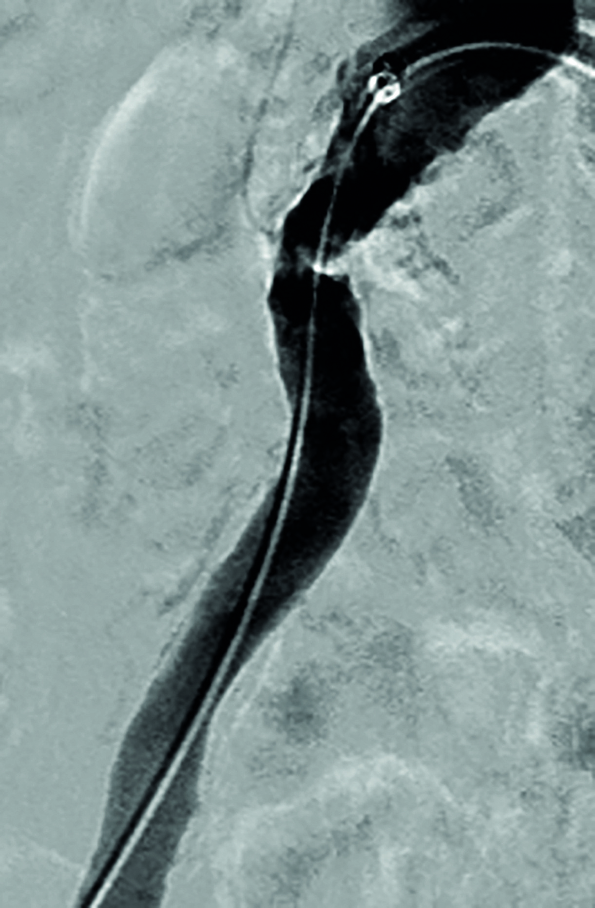 Balloon-expandable covered stent reveals promise as endovascular ...