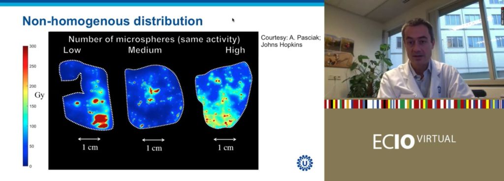Personalised treatment planning “the future” of radioembolization