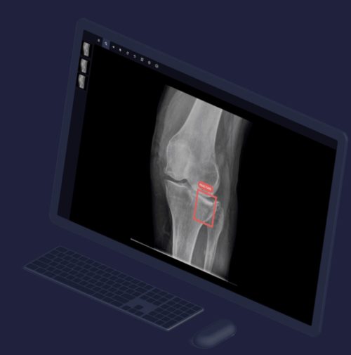 AI software BoneView helps radiologists detect and localise fractures