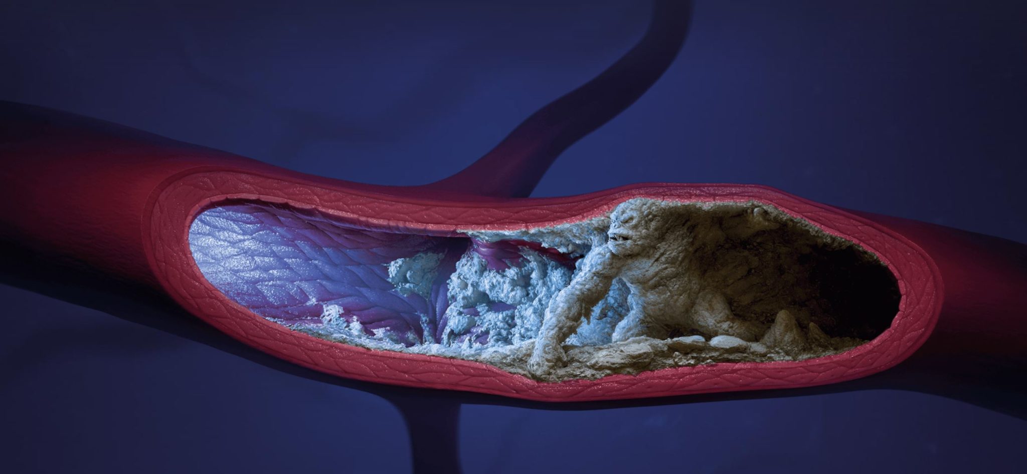 Positive initial data presented at ISET for the Auryon atherectomy system