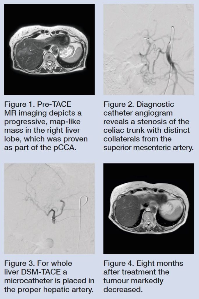 Degradable starch microspheres offer greater flexibility with TACE