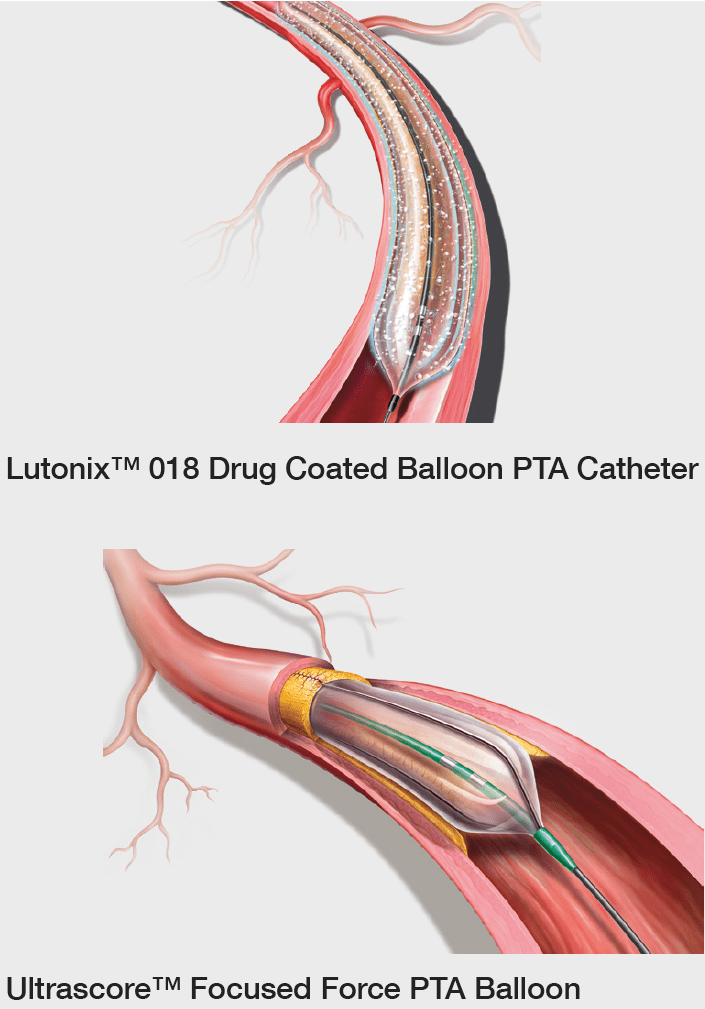 Case report: Recanalisation of a long SFA occlusion with Ultrascore ...