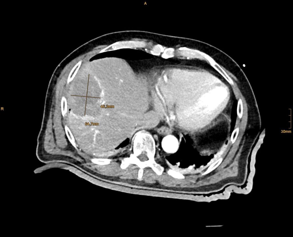 "Interventional oncology must become reliable and reproducible”