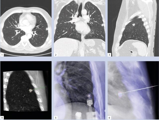 Micromate™ reduces complications, radiation exposure and procedure time ...
