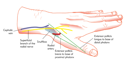 How to manage access via the distal radial route - Interventional News
