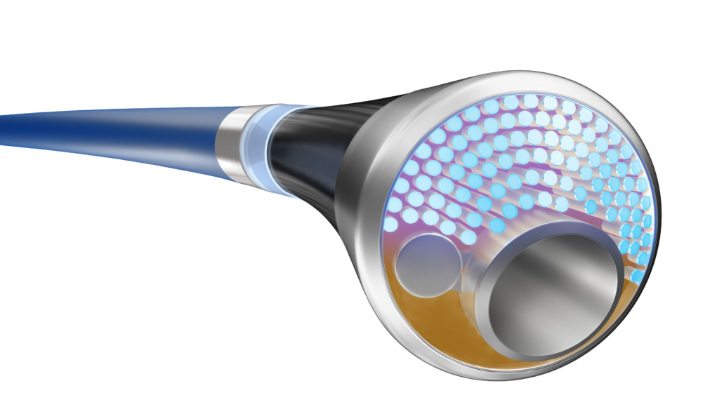 First patient enrolled in study of integrated laser atherectomy and IVL catheter ...